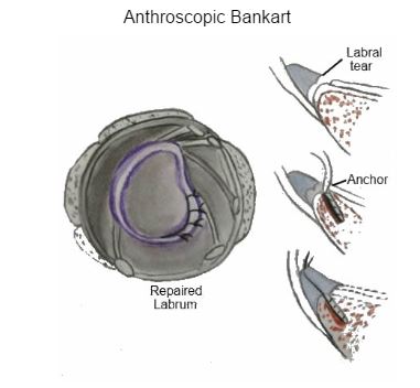 The Shoulder Practice | Cape Town | Shoulder Dislocations
